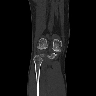 CT Knee - Radiology Imaging