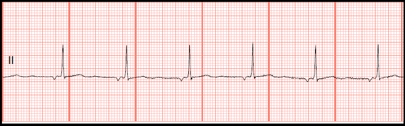 Basic EKG Rhythm Test 28