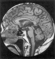 Medical Treatment Pictures-for Better Understanding: Machado-Joseph Disease