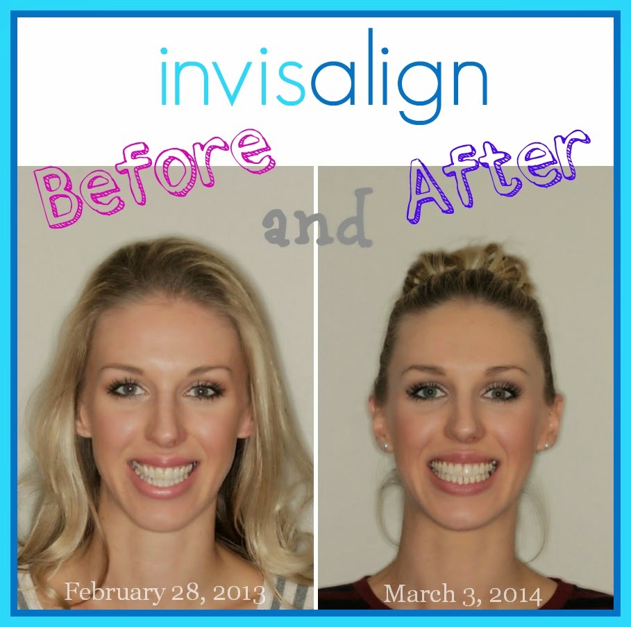 Sunshine!: Invisalign Update: 1 Year Appointment