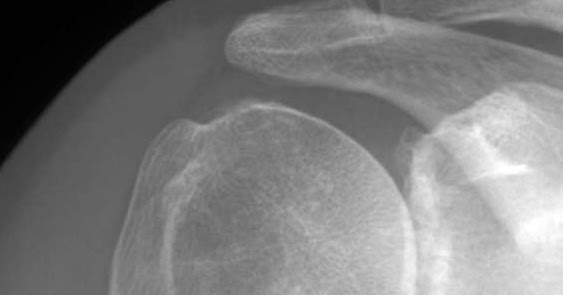UW Shoulder and Elbow Academy: B2 glenoid: simple evaluation and ...