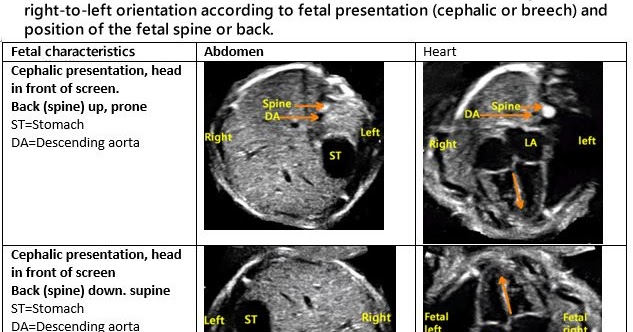 Bushra's Ultrasound Blog: Normal Situs With Different Fetal Positions