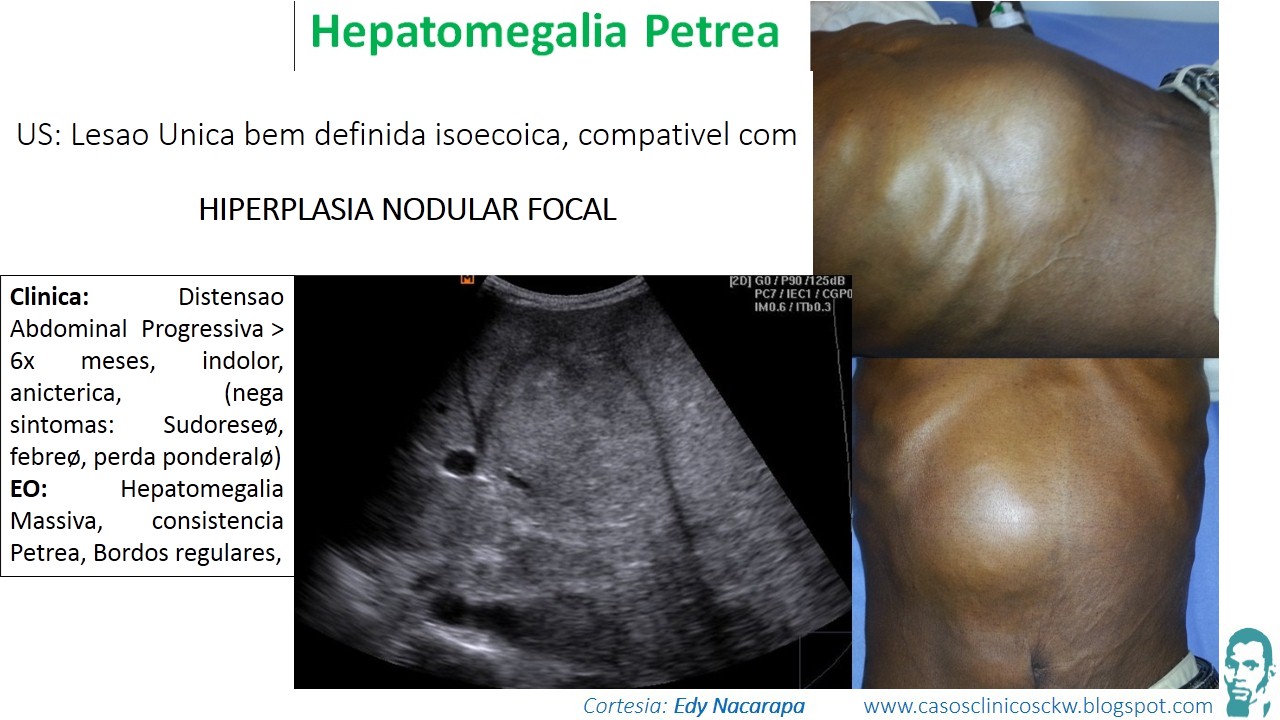 Casos Clinicos: FNH Hiperplasia Nodular Focal