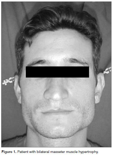 Odontology Student: Idiopathic Masseter Muscle Hypertrophy