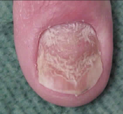 psoriasis: le psoriasis de l’ongle