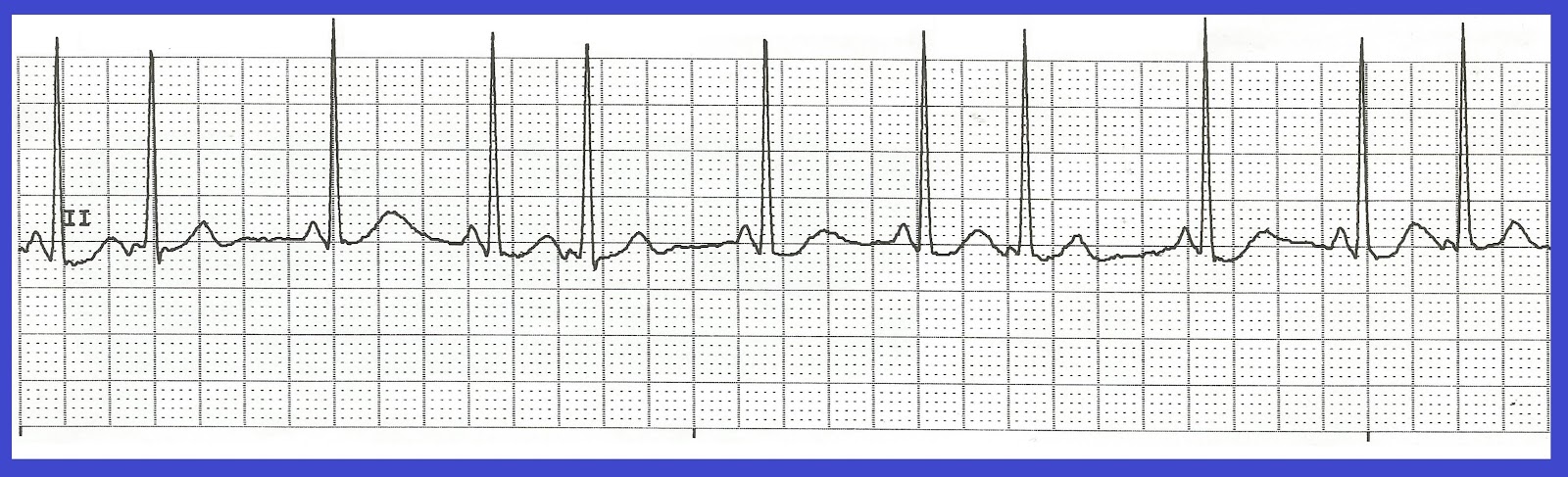 Float Nurse: Practice EKG Rhythm Strips 195