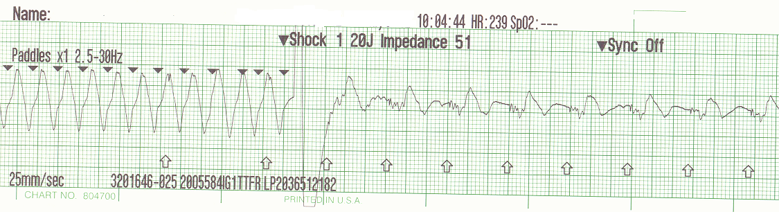 Pedi cardiology: DC Cardioversion: Apparent VT. But,...