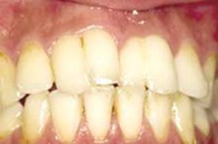 tooth fusion vs Concrescence vs gemination