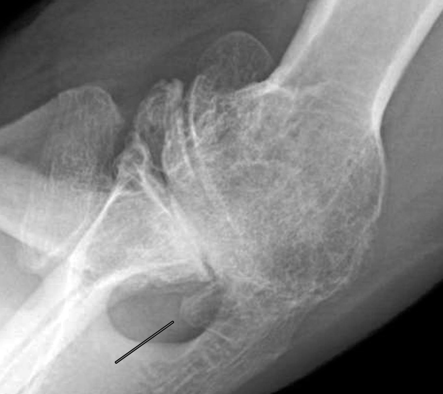 UW Shoulder and Elbow Academy: Shoulder joint replacement - special ...