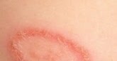 Ringworm and Children Treatment | Children Health