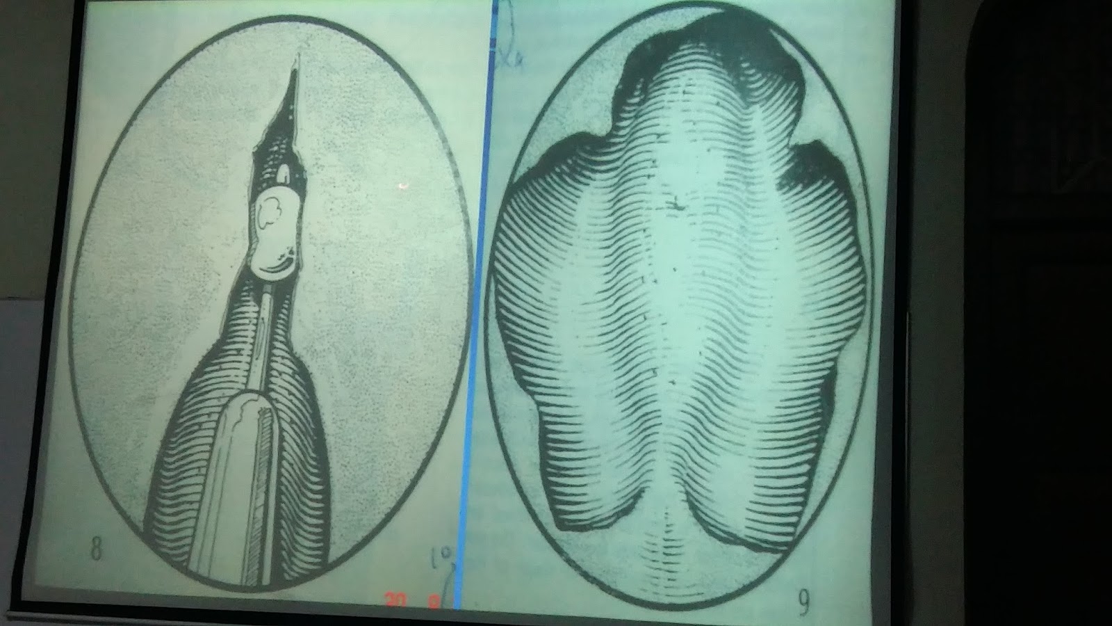 Lecture Slides : Paeds Surgery ; Vesicoureteral Reflux(VUR) And ...