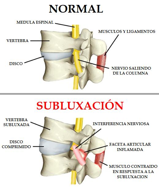 Subluxacion