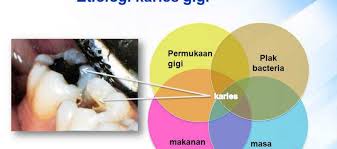 kesehatan gigi: KARIES GIGI