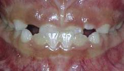 APARATOLOGIA ORTOPEDICA: BIONATOR CLASE III