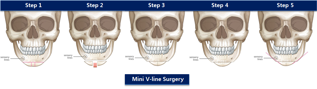 ID Hospital Korea: How to get the perfect V-shaped chin?