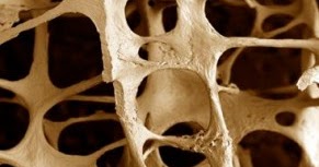 Maisfisio Cursos de Terapia Manual: Osteopenia – O que é? Causas ...