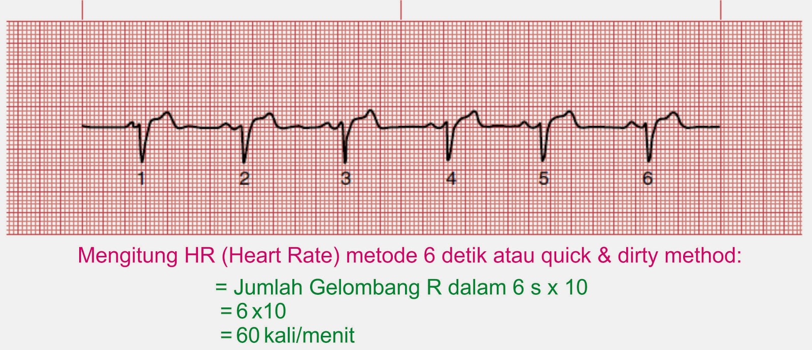 Interpretasi EKG 5 Langkah