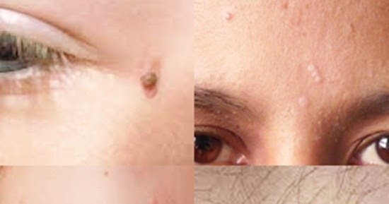 082179955777, cara menghilangkan kutil di wajah secara tradisional ...