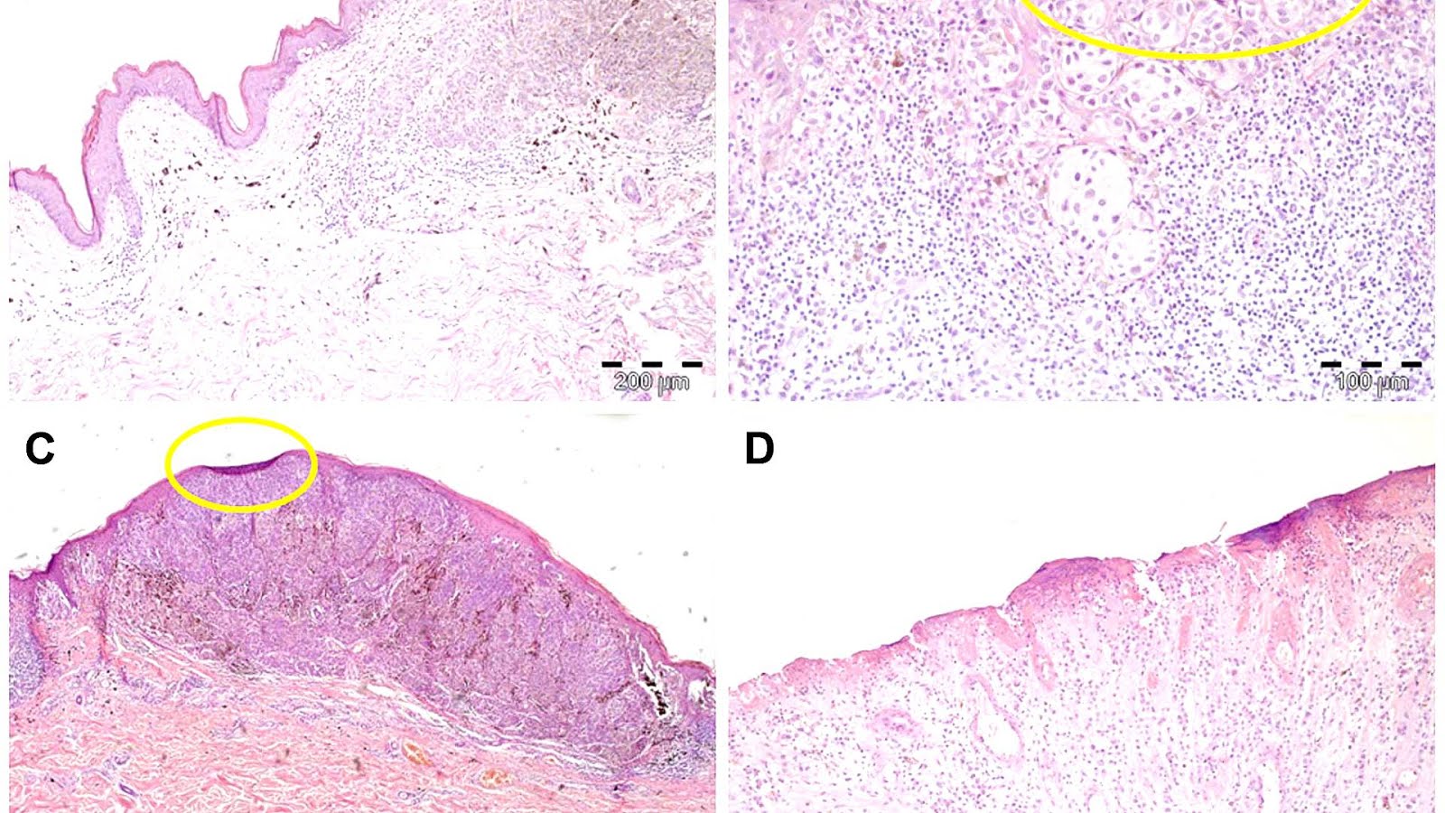 Melanoma - Ulcerated Melanoma Pictures - Ulcer Choices