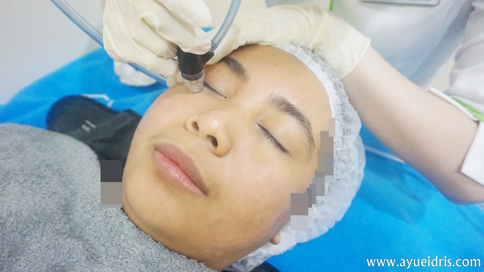 Rawatan Facial SilkPeel Dermalinfusion di Revival Medical Clinic | AYUE ...