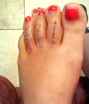 Recovery for Hammer Toe/Toe Shortening Surgery