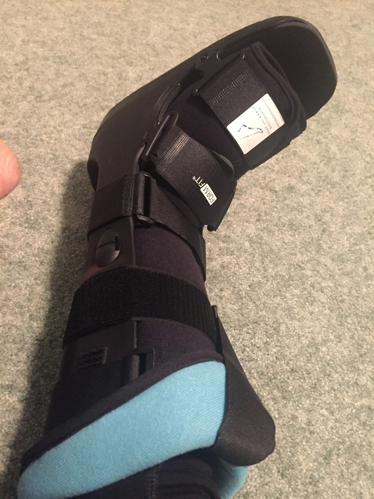 Before, During, & After Bunion Surgery...: First Two Weeks after ...