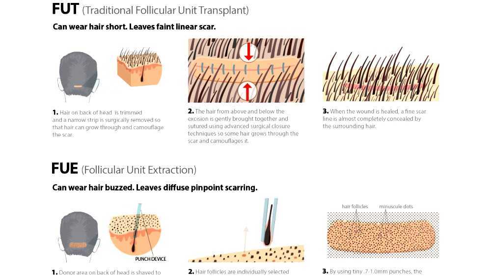 Follicular unit extraction