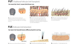 Follicular unit extraction