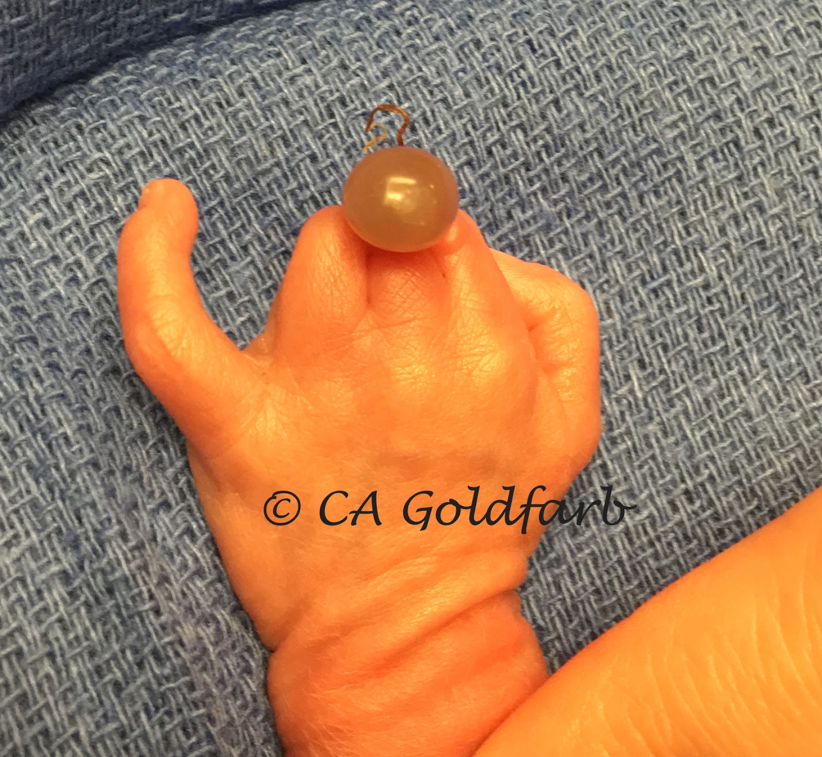 Finger at Risk- Amniotic Constriction Band | Congenital Hand and Arm ...