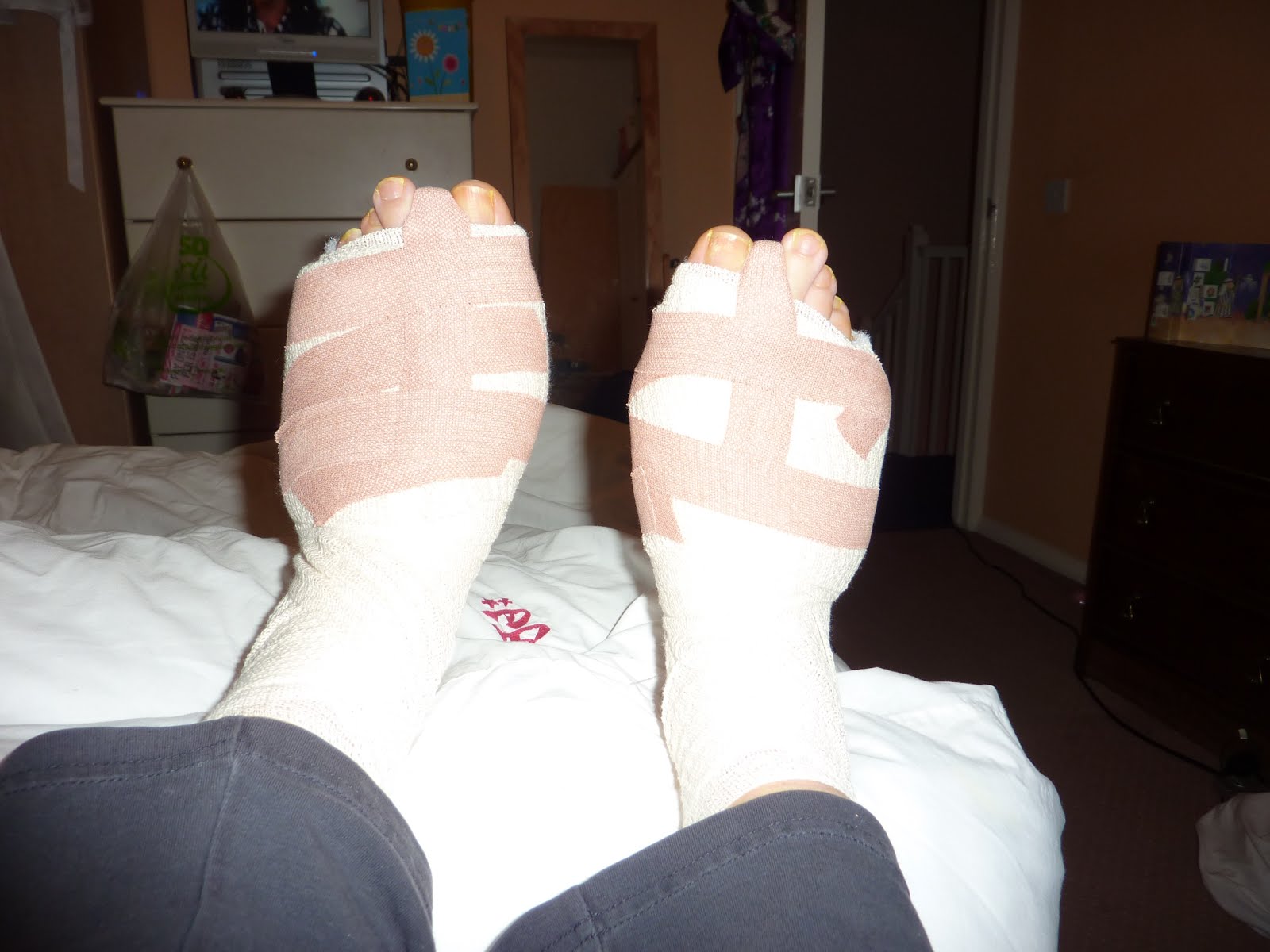 From bunions to beautiful feet: The big reveal! Sort of. With pictures.