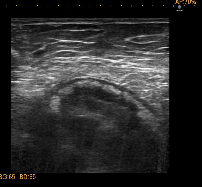 Ventral Hernia Ultrasound