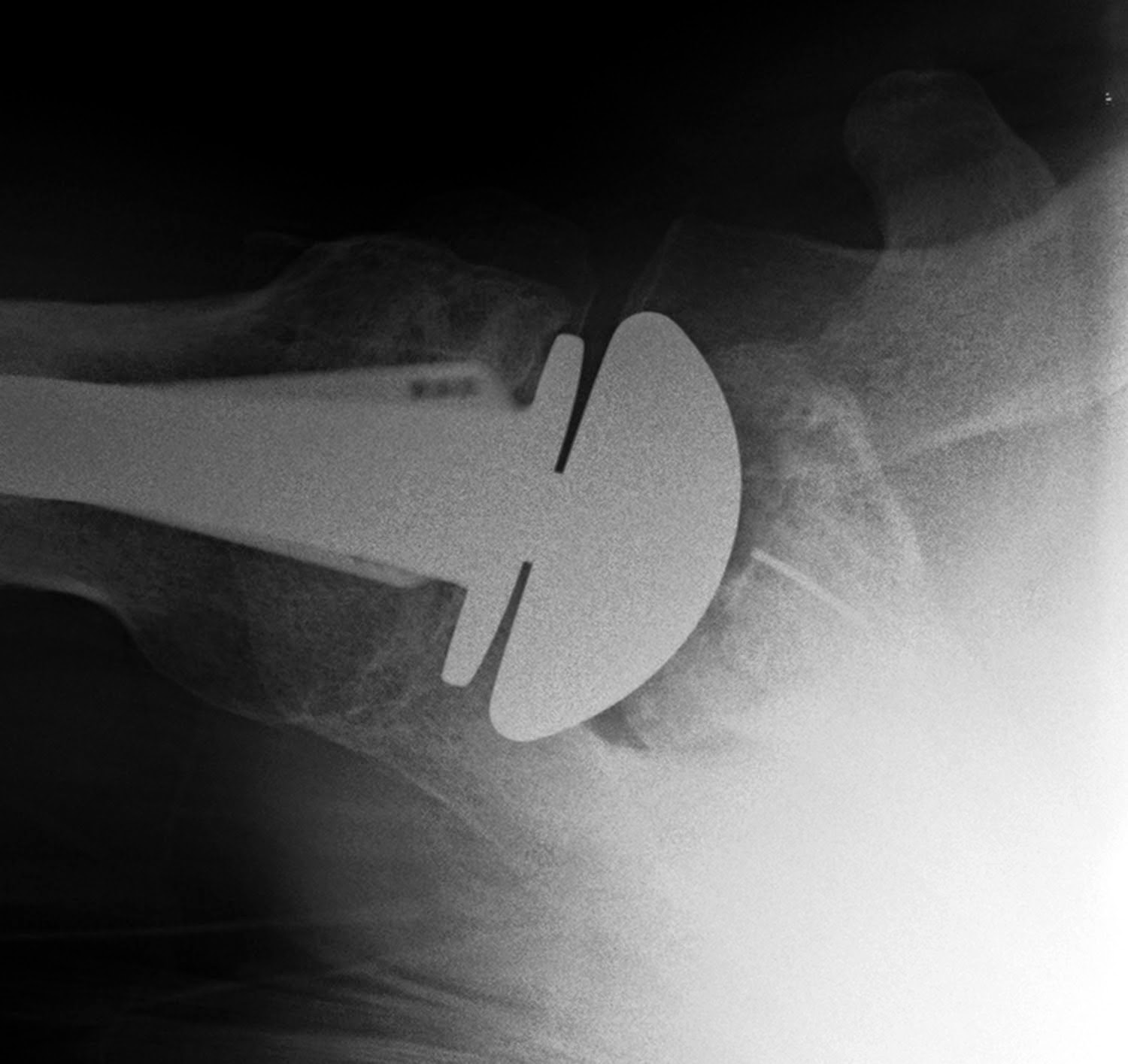 UW Shoulder and Elbow Academy: Failure of anatomic total shoulder joint ...