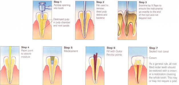 Tooth & Gums: Root Canal Therapy