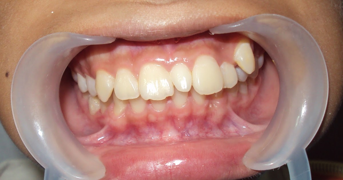 TOOTHFULNESS: Got Extra Tooth