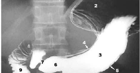 Radiografía Seriada Esofago-Gastro-Duodenal