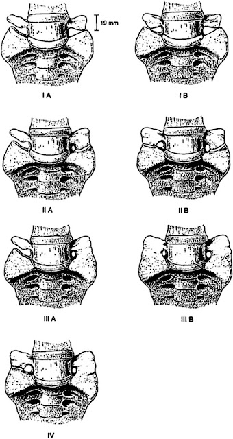 Skull and Spine: Lumbosacral transitional vertebrae