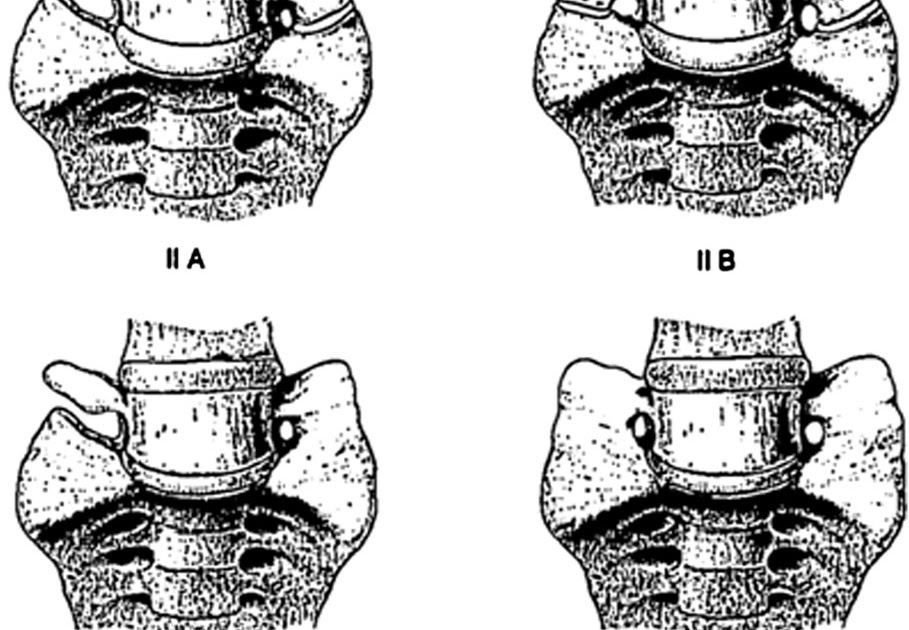 Skull and Spine: Lumbosacral transitional vertebrae