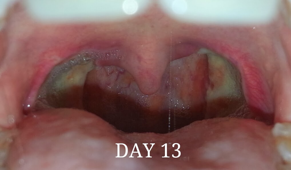 Jill's Tonsillectomy: November 2013