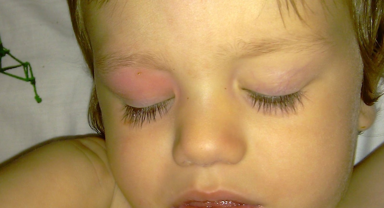 Skeeter Syndrome: Getting Closer...