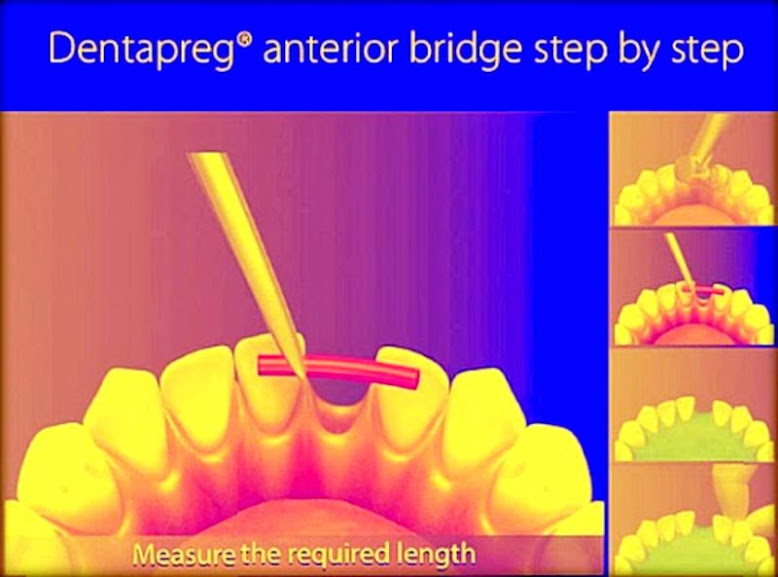 DENTAPREG: Anterior Bridge step by step - Odonto-Tv