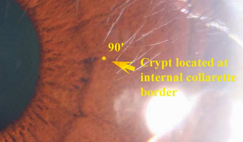 Modern & Multidimensional Iridology: IPB Morphologies Vs Crypt Located ...