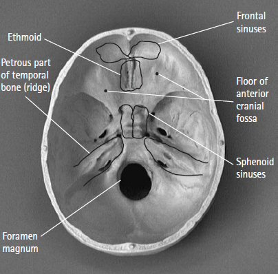 Mundo da Radiologia: Seios Paranasais