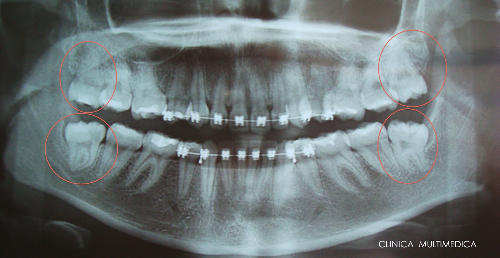 Odontología - Elsa & Asociados: Tercer molar o molar del juicio.