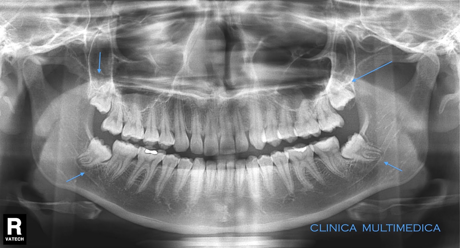 Odontología - Elsa & Asociados: Tercer molar o molar del juicio.