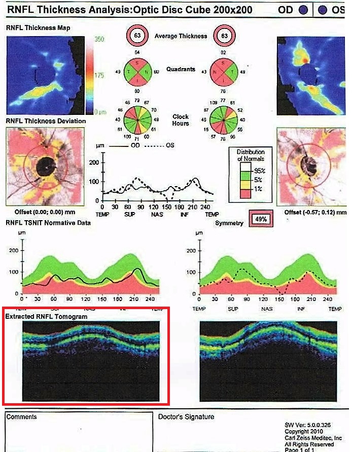 GLAUCOMA SPECIALIST BLOG: "THE GLOG"