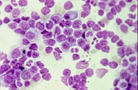 ♥Generalidades de las Leucemias♥: CLASIFICACIÓN DE LAS LEUCEMIAS