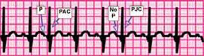 Premature Atrial and Junctional Complex ~ Nursing