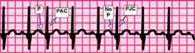 Premature Atrial and Junctional Complex ~ Nursing
