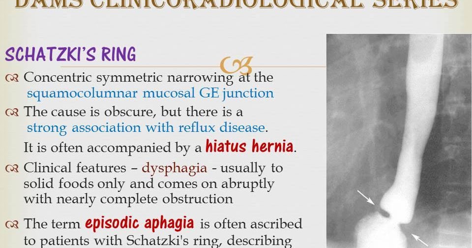 Schatzki's Ring-Clinicoradiological Series - Sumer's Radiology Blog