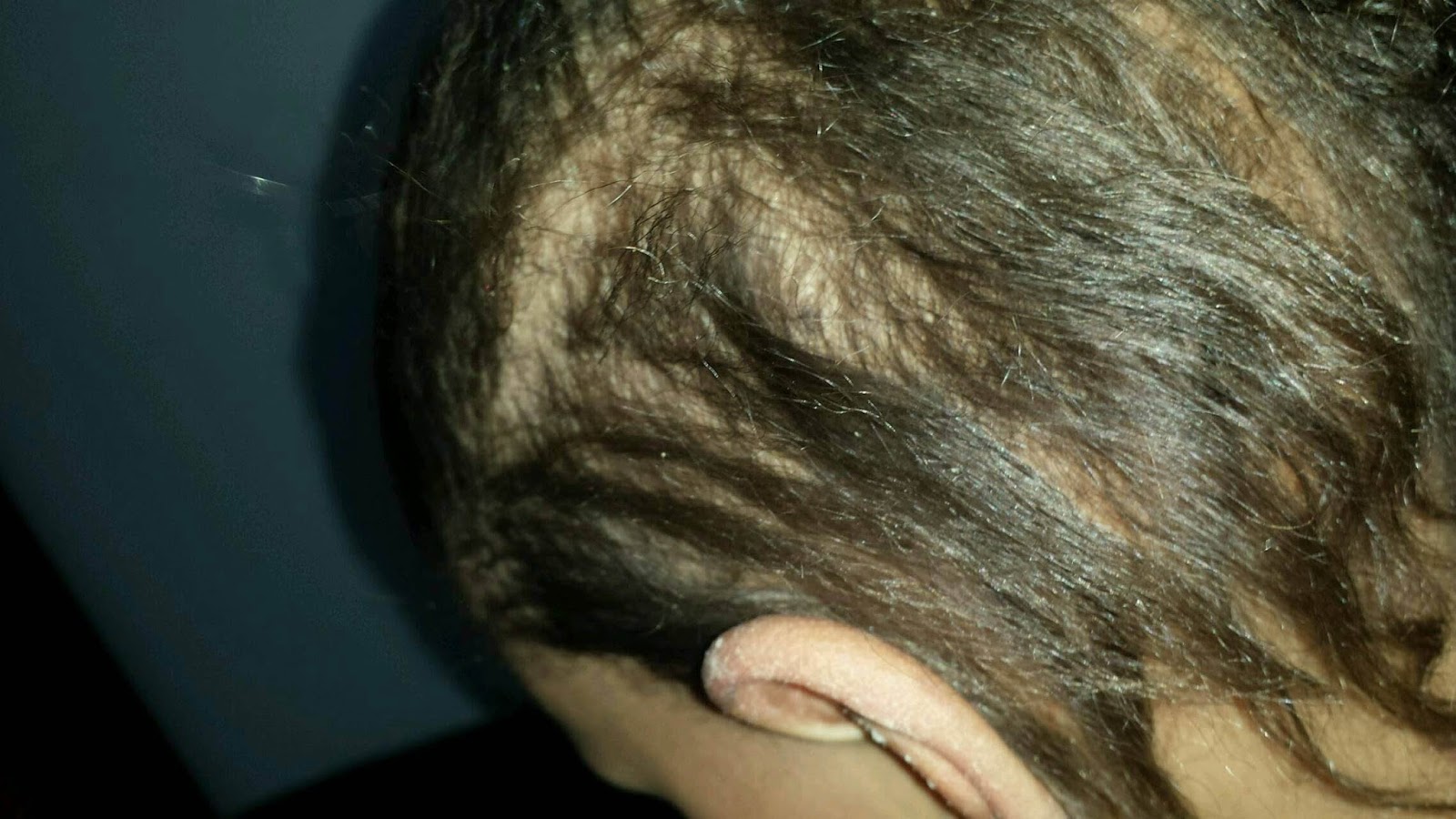 VIRTUAL GRAND ROUNDS IN DERMATOLOGY 2.0: Tay Syndrome (Trichothiodystrophy)